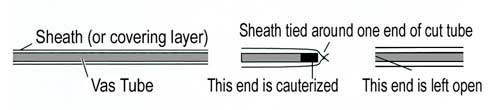 The No-Scalpel Vasectomy Procedure at Comfort Procedures Dallas ...